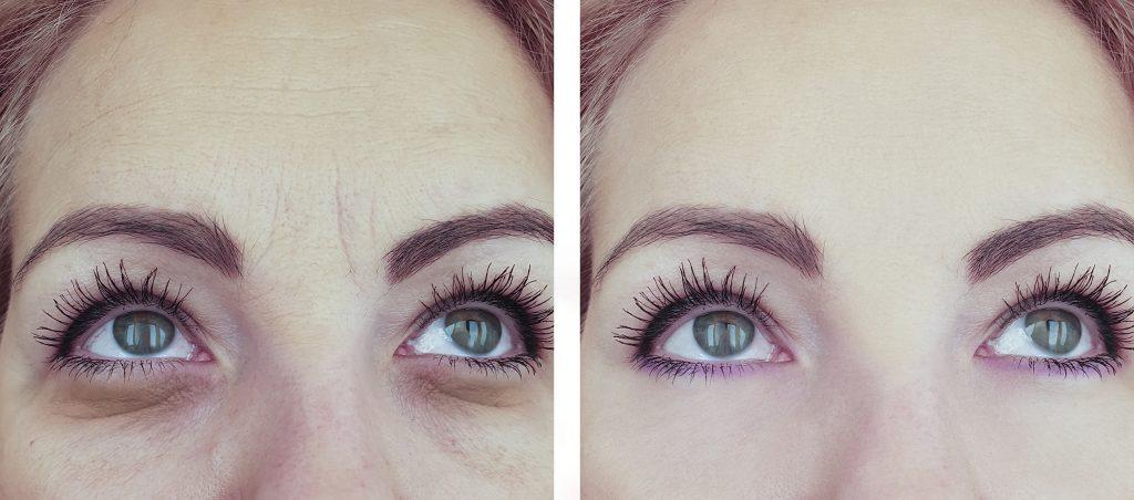 What is Baby BOTOX? – The Glam House Clinic